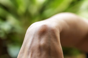 was ist eine Zyste: Ursachen, 13 Arten, Symptome, Behandlungen