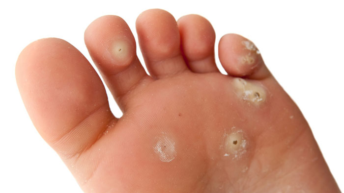 Dornwarzen (Plantarwarzen): Ursachen, Behandlung, Prävention, Erholung