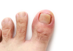 Paronychie: Ursachen, Symptome, Behandlung, Diagnose