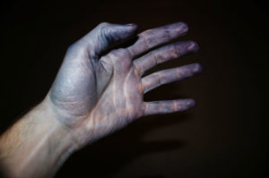 periphere Zyanose (blaue Hände und Füße): Ursachen, Diagnose, Behandlung