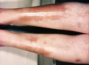 Diabetische Dermopathie: Ursachen, Symptome, Behandlungen und Bilder