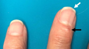 Digitale Myxoidzyste: Ursachen, Symptome, Bilder und Behandlung