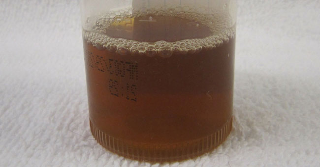 Dunkler Urin: Ursachen, Prävention und wann man Hilfe sucht