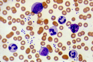 Granulozytose: Ursachen, Diagnose & Behandlungen