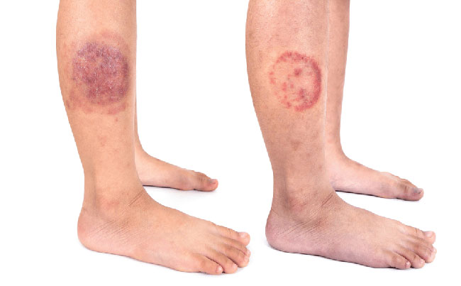 Nummular Eczema vs Ringworm: What's the Difference? - Evolving World