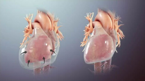 Perikard: Funktion, Rolle im Körper und damit verbundene Bedingungen