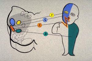 Wallenberg-Syndrom: Definition und Patientenaufklärung