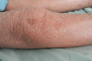 Xerosis Cutis: Ursachen, Symptome und Behandlungen