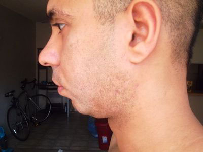 Zurückliegendes Kinn: Bilder, Ursachen, Übungen und Operationen